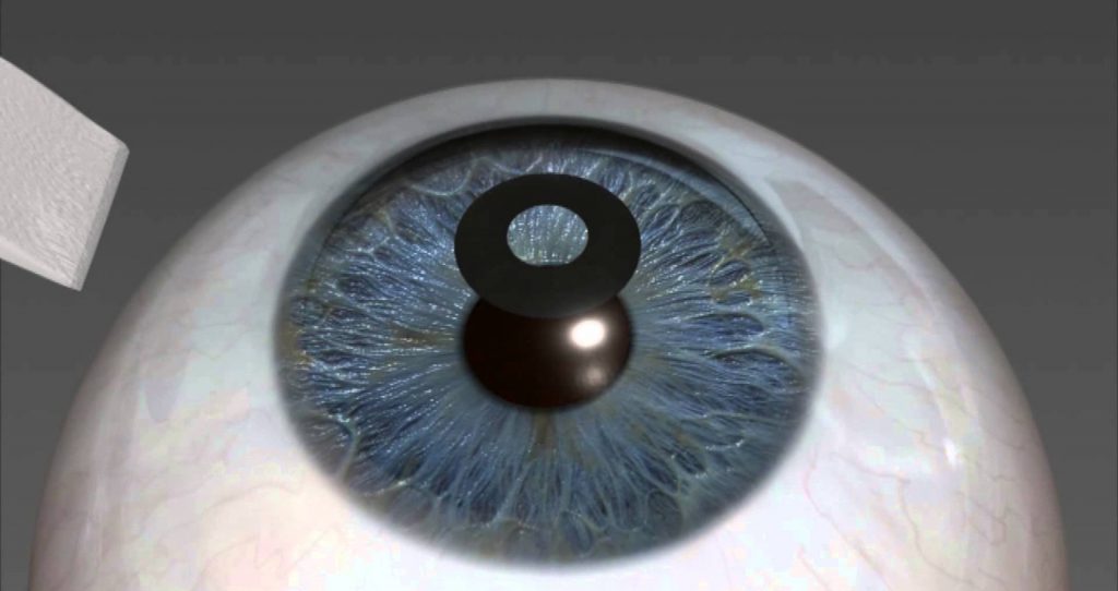 Kamra Inlays: Good or Bad?