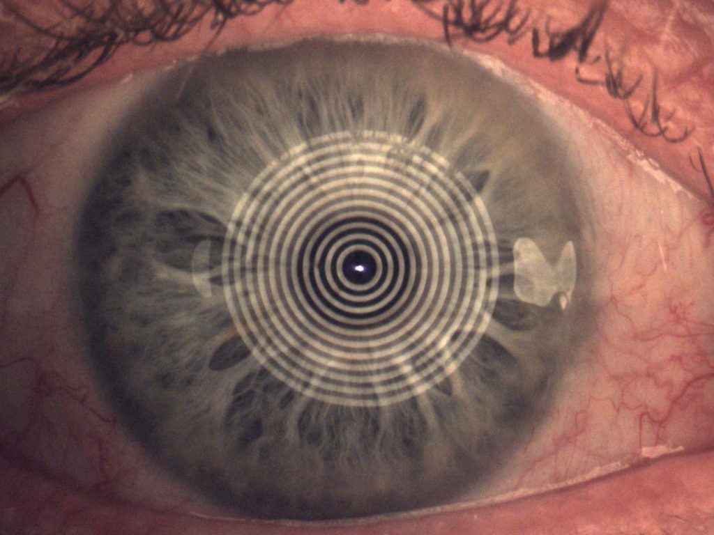 FineVision Trifocal Intraocular Lenses