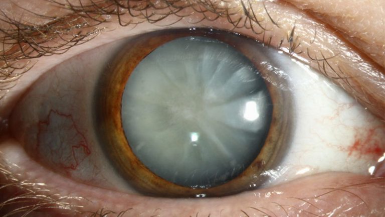 3 Different Types of Cataracts