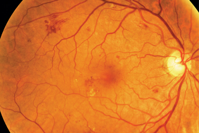 Intravitreal Injections: What You Need to Know