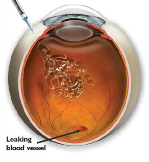 Intravitreal Injections: What You Need to Know
