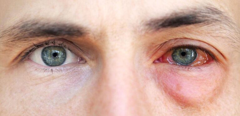 Eye Injuries - When to Seek Medical Care